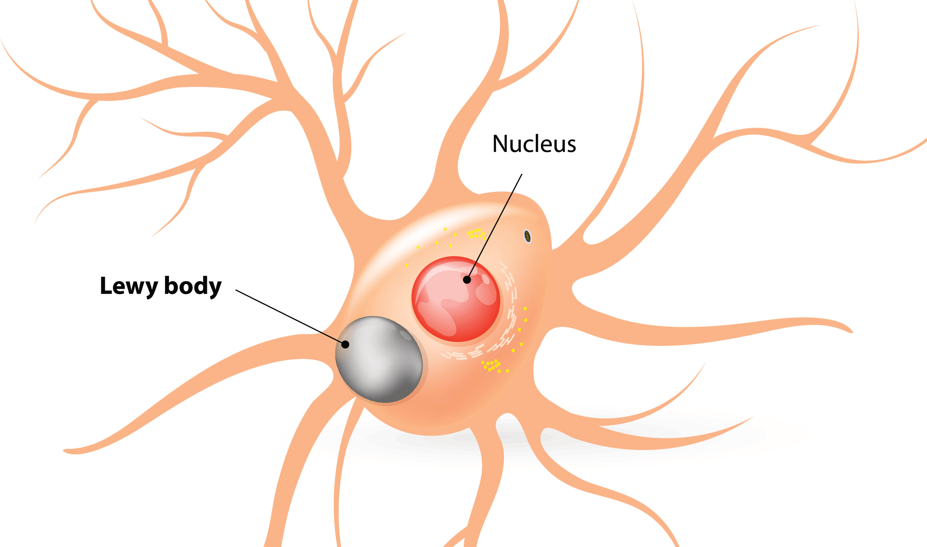 Dementia With Lewy Bodies Press Office Newcastle University