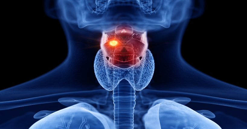 Voice box cancer - Press Office - Newcastle University