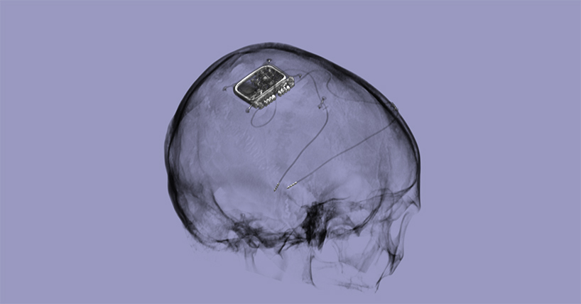 MRC CoRE in Restorative Neural Dynamics - Press Office - Newcastle ...