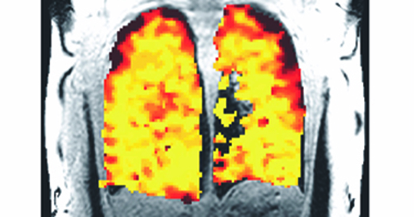 New scan method unveils lung function secrets - Press Office ...