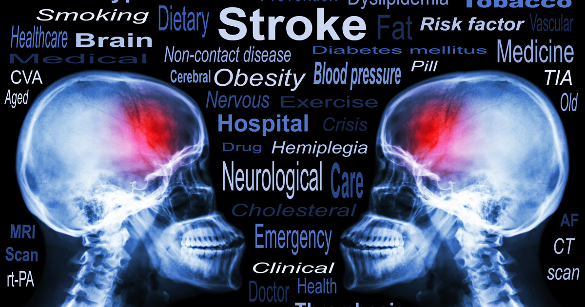 Stroke study - Press Office - Newcastle University